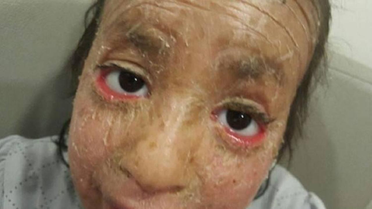 Derisi balık pulu gibi dökülüyor - Haber 7 SAĞLIK