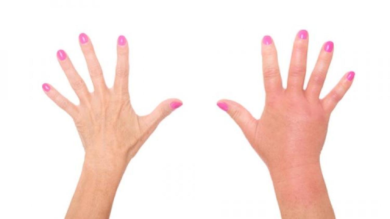 Ödem nedir, nasıl oluşur? Ödemin nedenleri ve tedavisi… - Haber 7 SAĞLIK