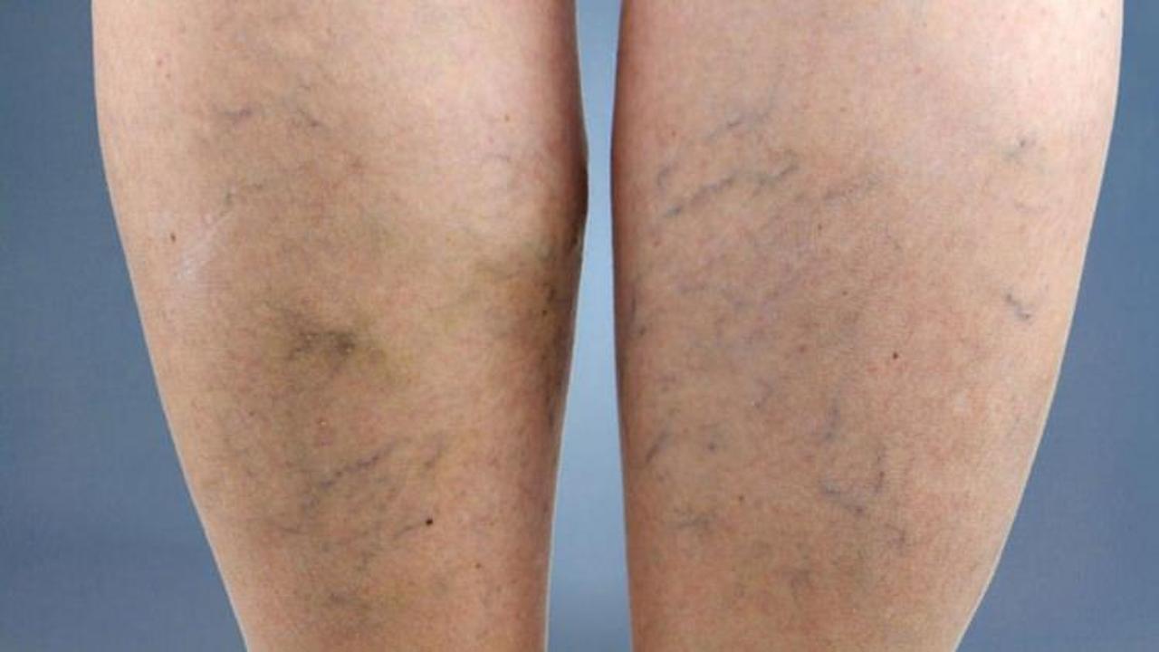 Varis neden olur? Varis nasıl tedavi edilir? Varise bitkisel çözüm ...