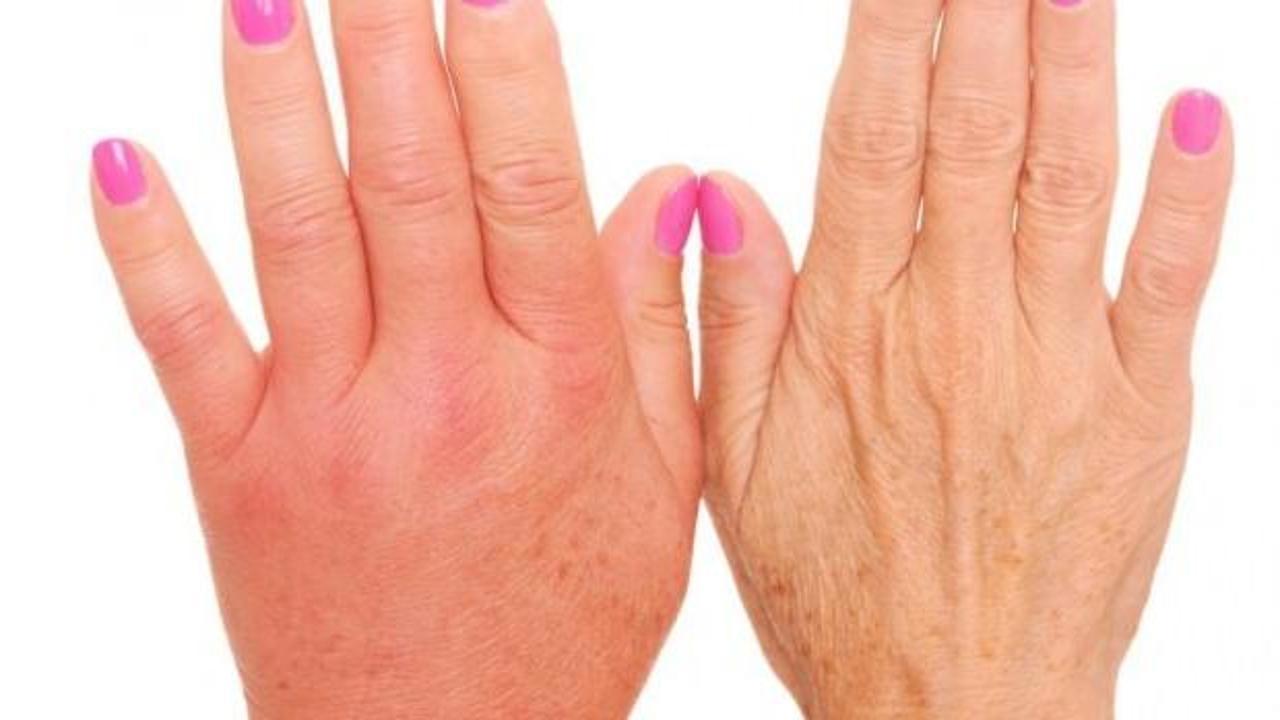 Fil Hastalığı nedir, belirtileri? Fil Hastalığı (Lenfödem) nedenleri ...