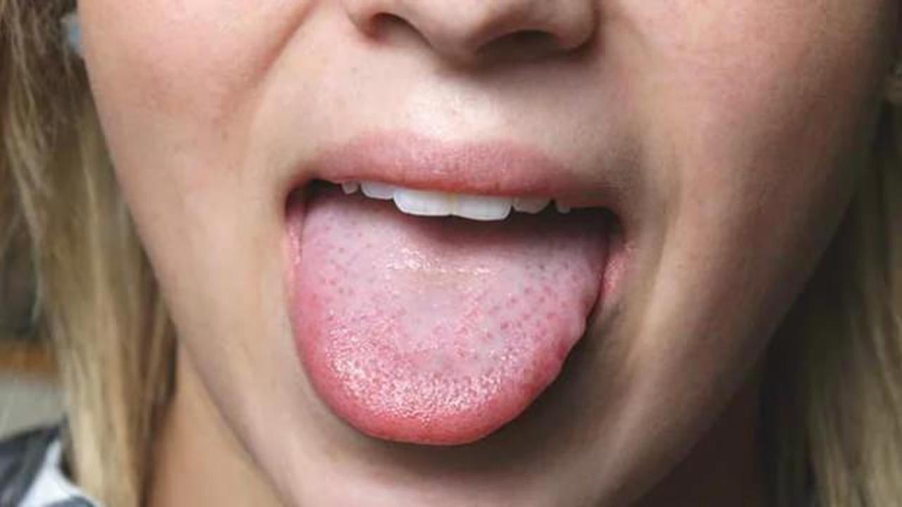 Dil kanserinin belirtileri nelerdir? Dil kanseri neden ortaya çıkar ...
