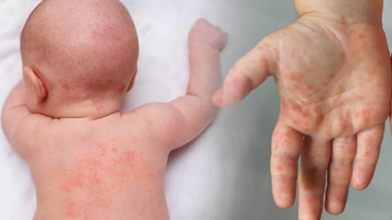 Pişik neden olur? Pişiğe Ne İyi Gelir, Pişik Nasıl Geçer? Bebeklerde Ve ...