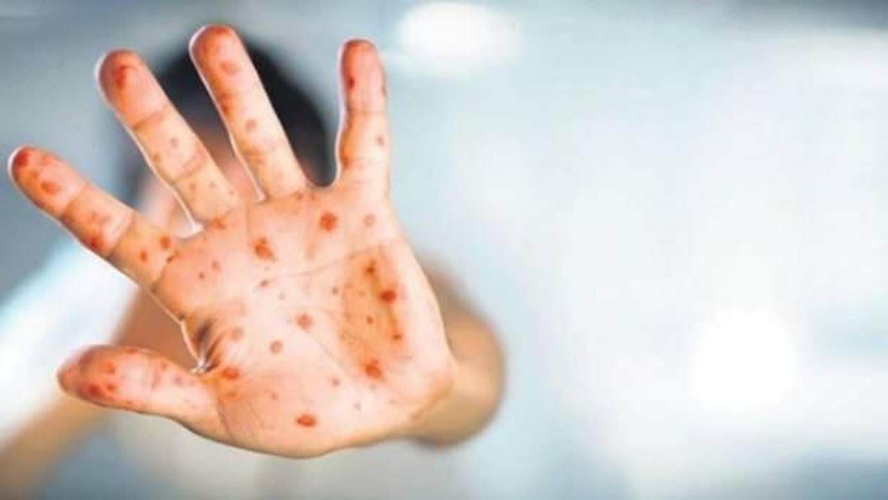 AB ülkelerinde maymun çiçeği vakalarında son rakam - Haber 7 SAĞLIK