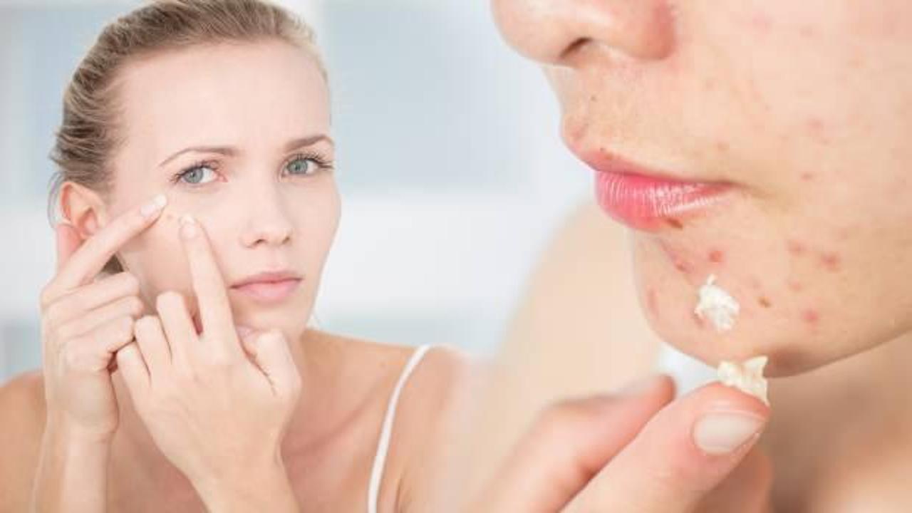 Aktif sivilce nasıl kurutulur? Sivilce izleri nasıl geçer? - Haber 7 SAĞLIK