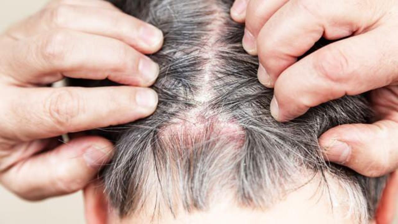 Sedef hastalığı geçer mi? Tedavisi ve ilacı var mı: Sedef hastalığının ...