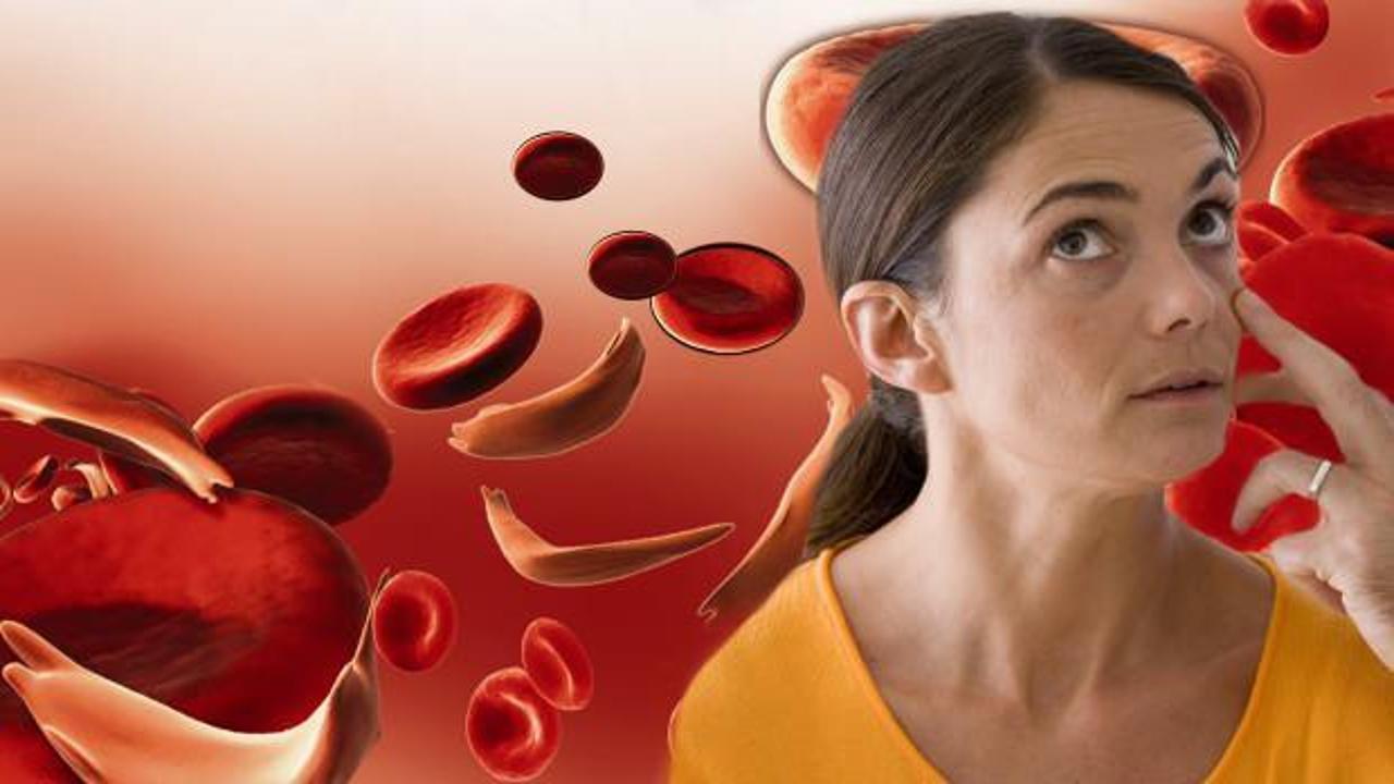 Anemi göz ardı ediliyor! Kronik anemi nedir, öldürür mü? - Haber 7 SAĞLIK