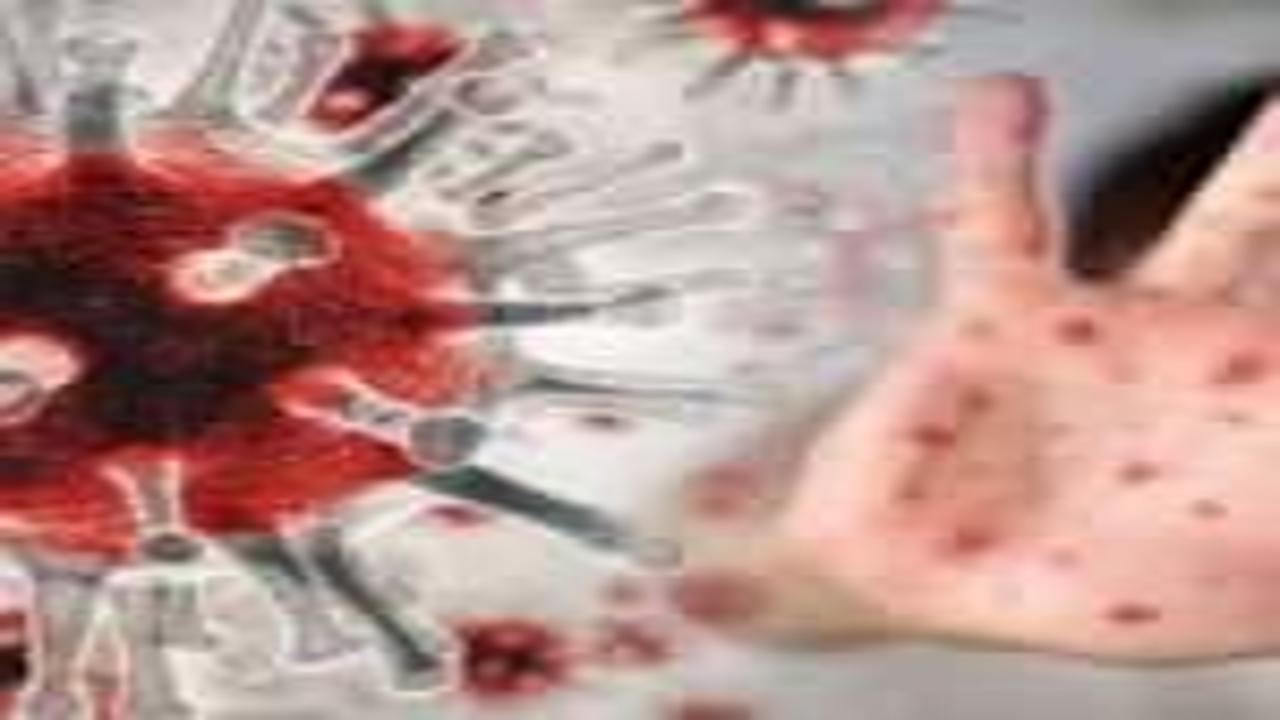 Maymun çiçeği belirtileri nelerdir? Maymun çiçeği virüsü tedavisi ... Maymun çiçeği belirtileri nelerdir? Maymun çiçeği virüsü tedavisi ...