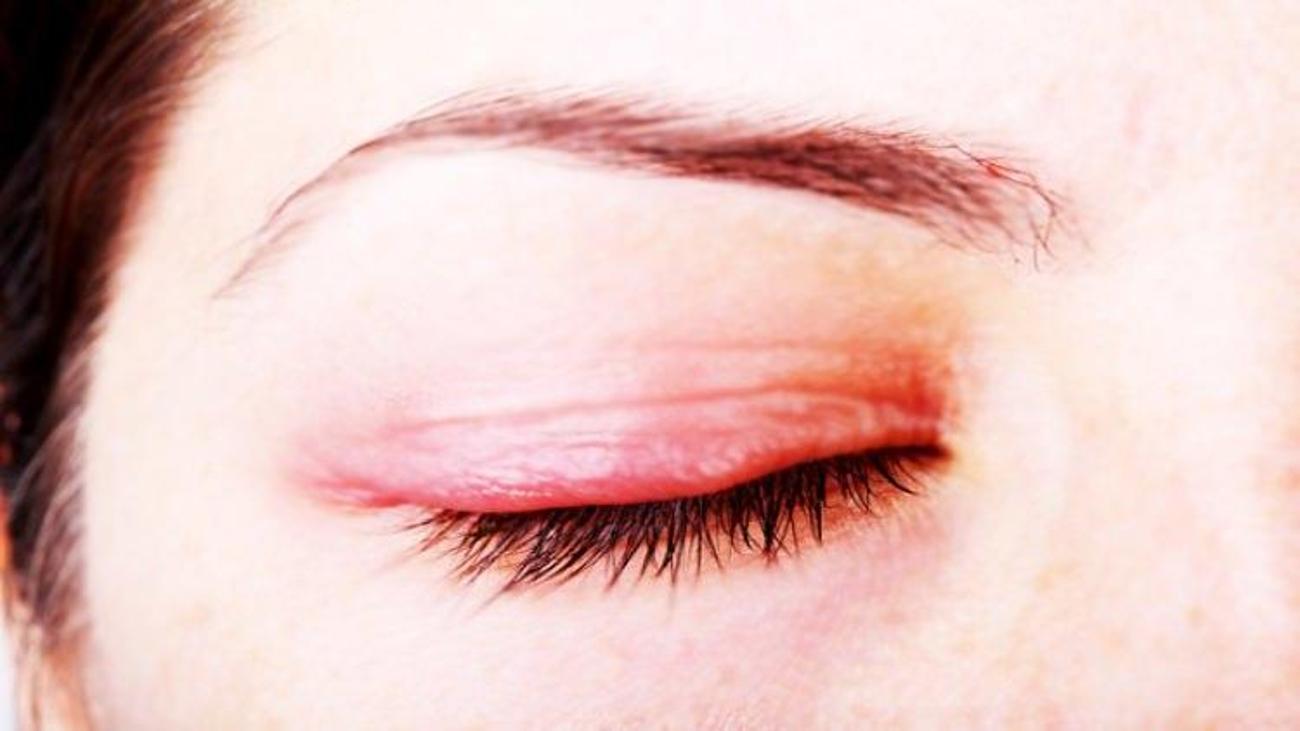 Arpacık nasıl geçer? - Sağlık Haberleri