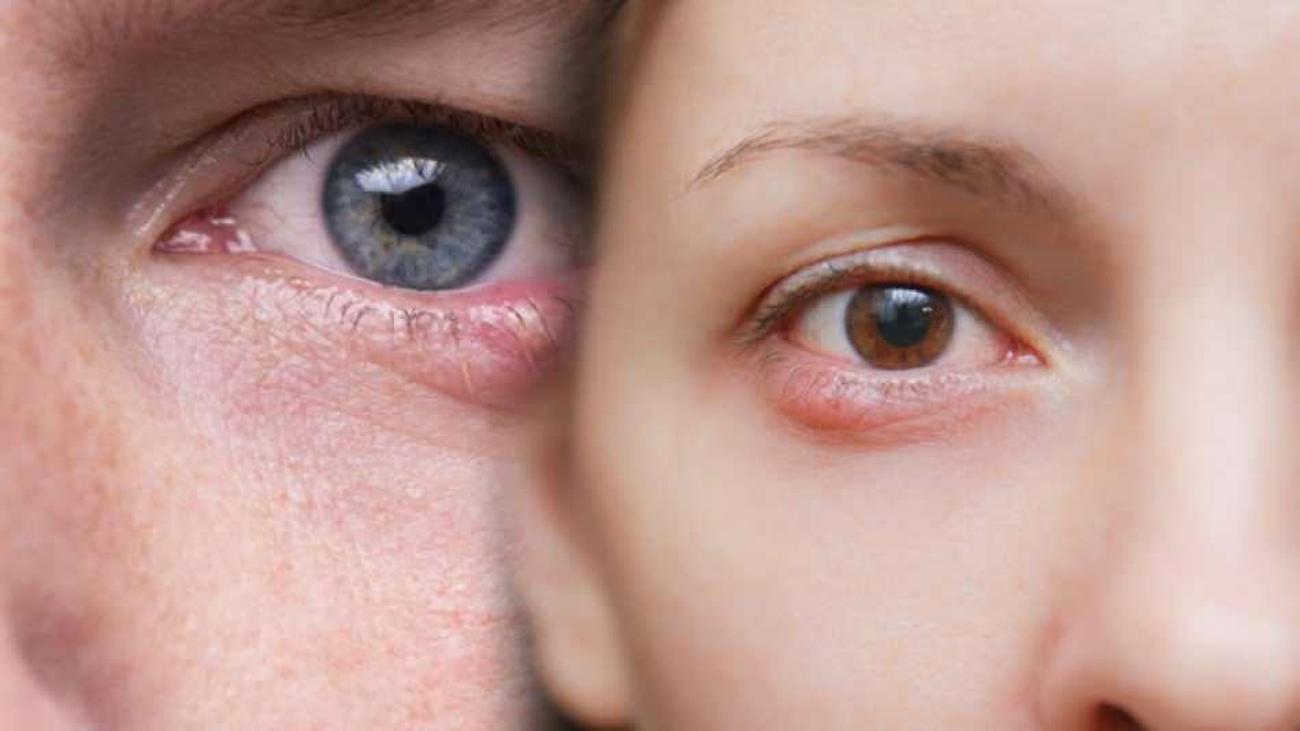 Arpacık en hızlı nasıl geçer? Göz hastalıkları ve arpacık için şifalı ...