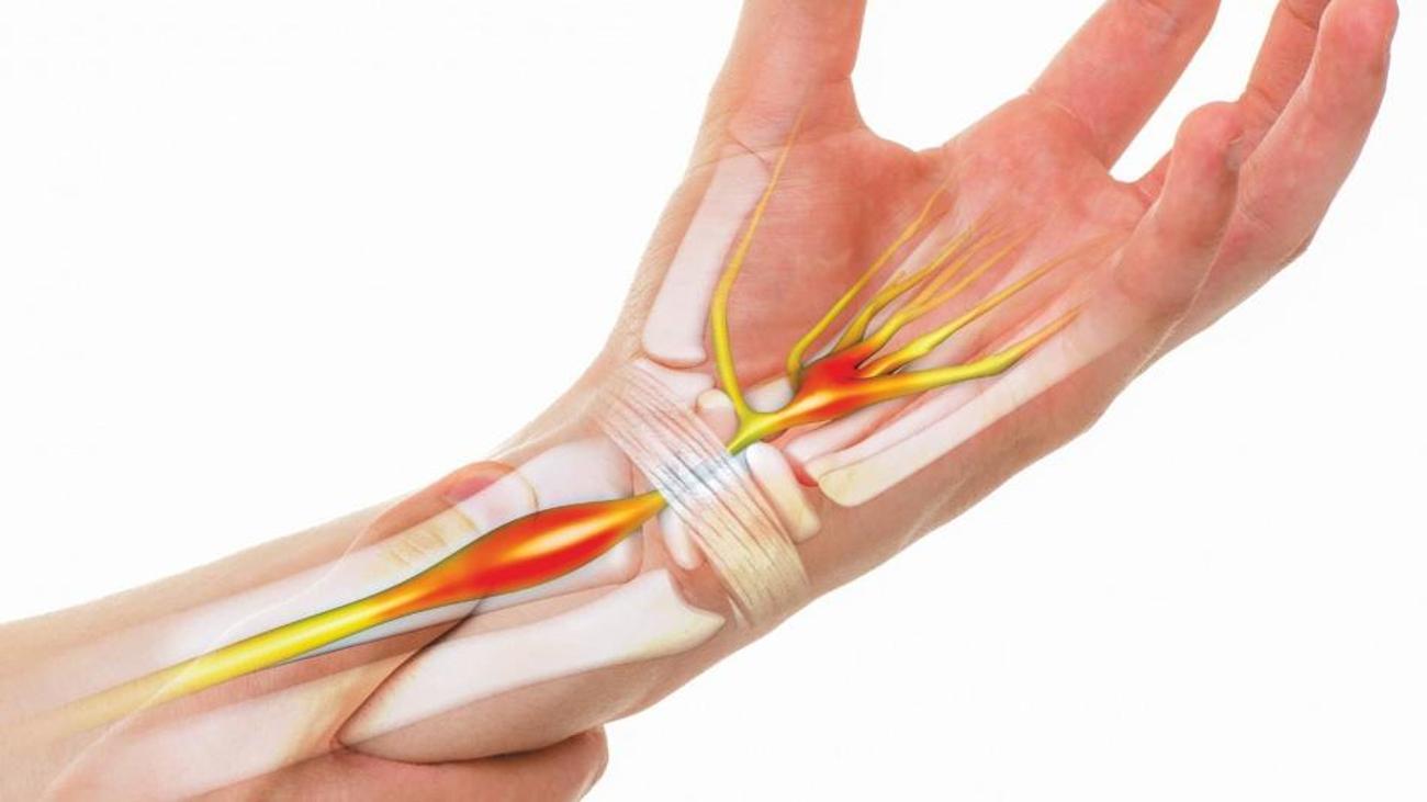 Karpal tünel sendromu nedir? Karpal tünel sendromunun belirtileri ...