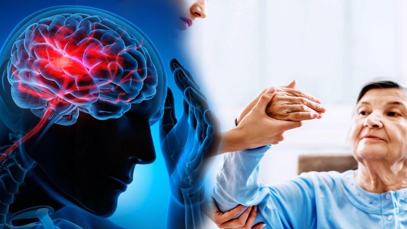 İnme nedir? İnmenin belirtileri nelerdir? İnmeden nasıl korunulur ...