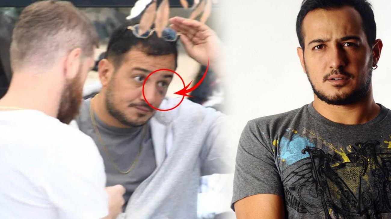 Sarp Apak dayak yemiş gibi! Ünlü oyuncunun gözüne ne oldu? - Magazin ...