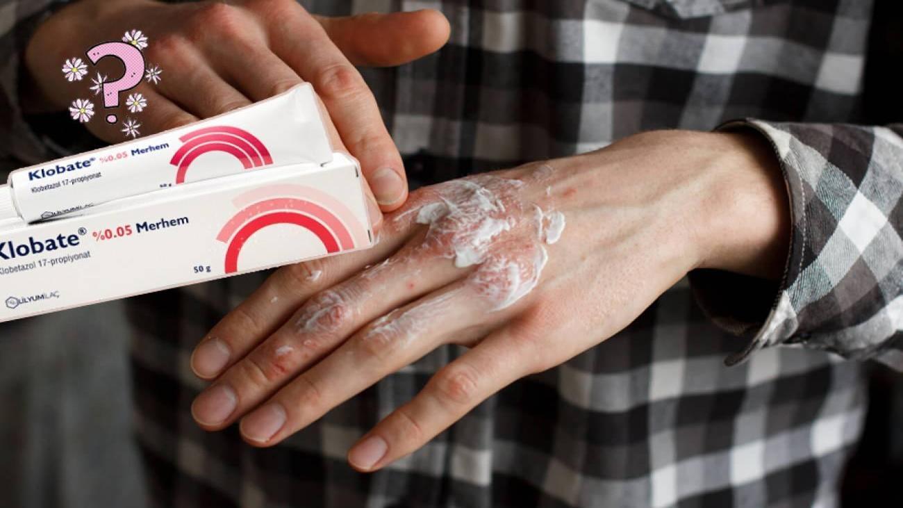 Klobate merhem ne işe yarar? Klobate merhem nasıl kullanılır? Klobate ...