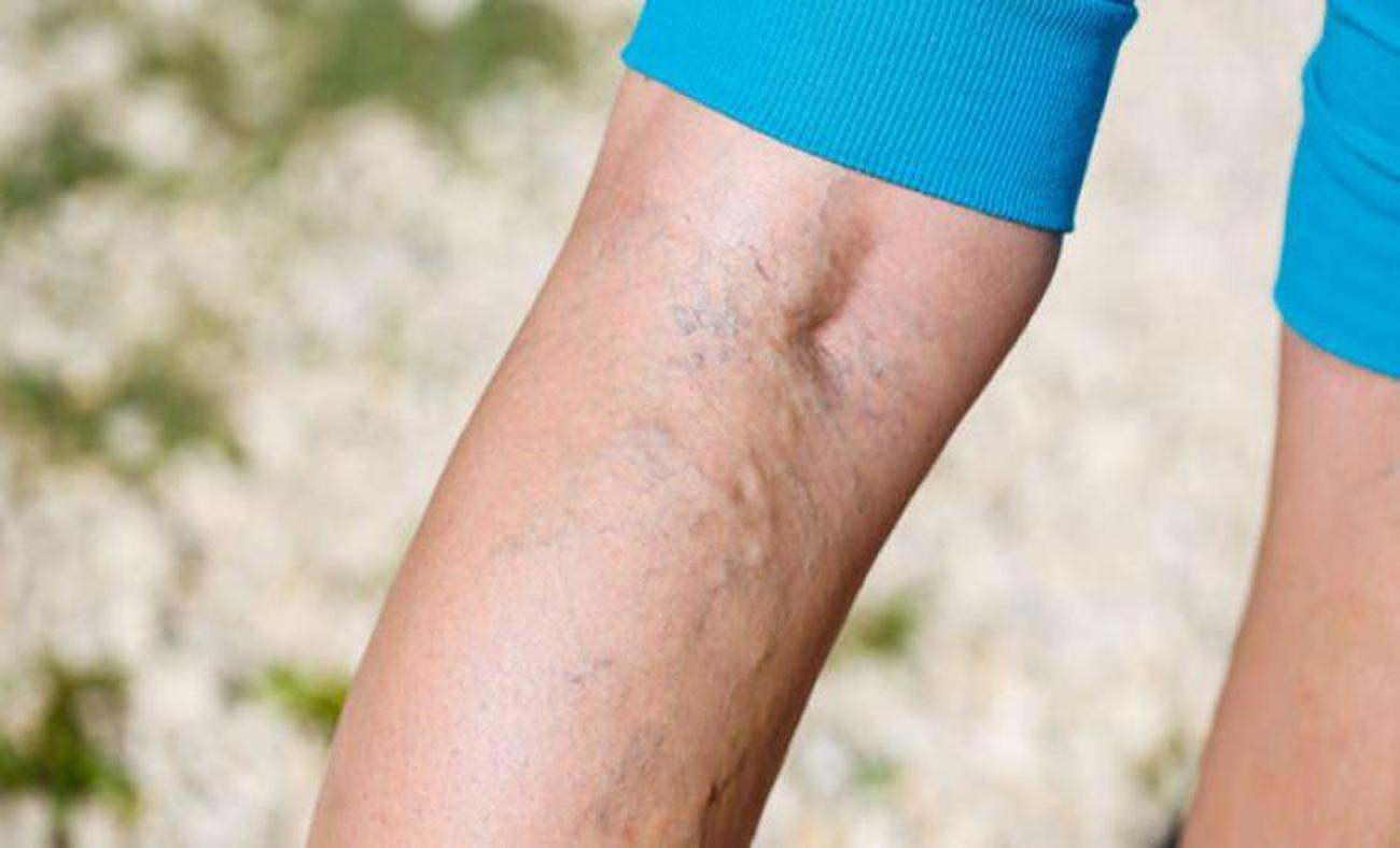 Varis nedir ve nasıl geçer? Varise bitkisel çözüm… - Sağlık Haberleri