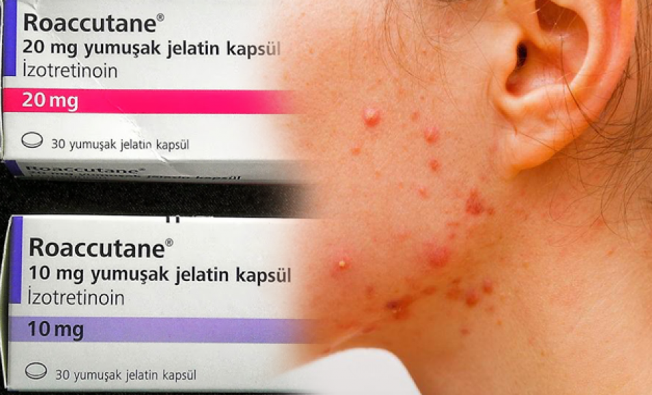 Roaccutane nedir? Nasıl kullanılır? Roaccutane yan etkileri nasıl geçer ...