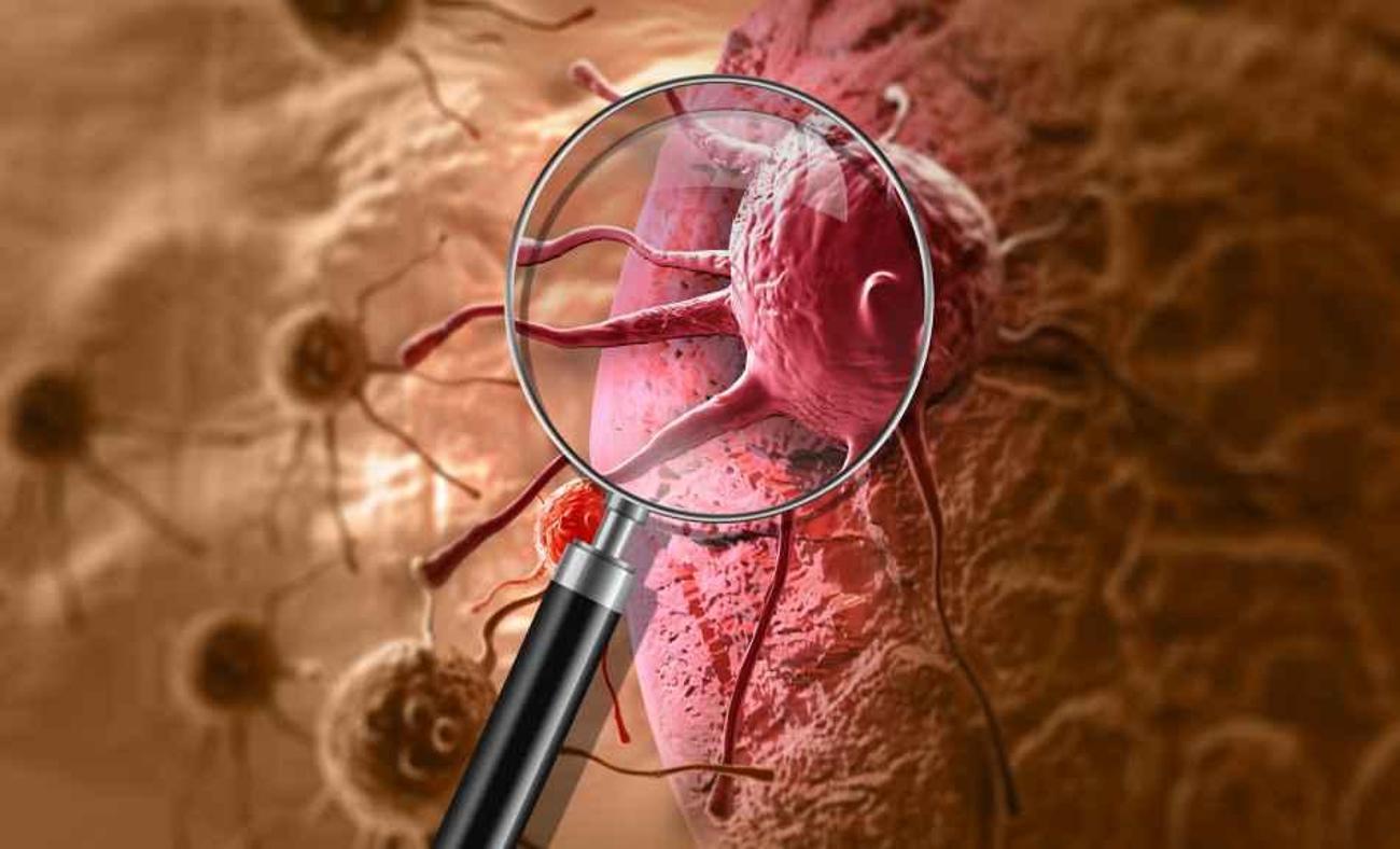 Kanser nedir ve belirtileri nelerdir? Kaç çeşit kanser vardır? Kanser ...