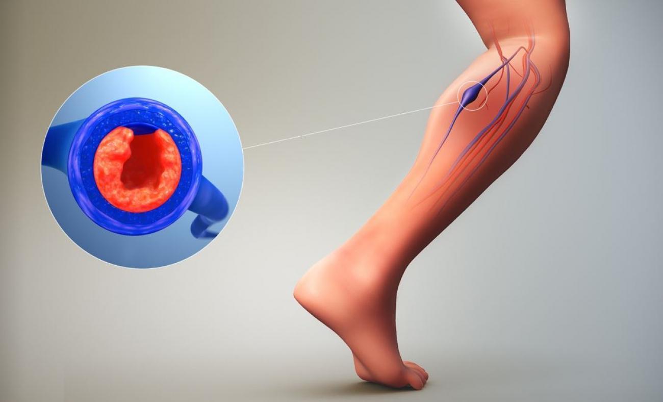 Emboli nedir ve neden olur? Embolinin belirtileri nelerdir? Emboli ...