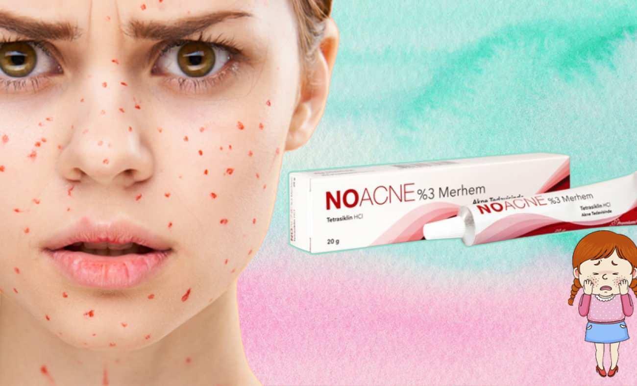 Noacne krem(merhem) ne işe yarar? Noacne krem nasıl kullanılır? Noacne ...