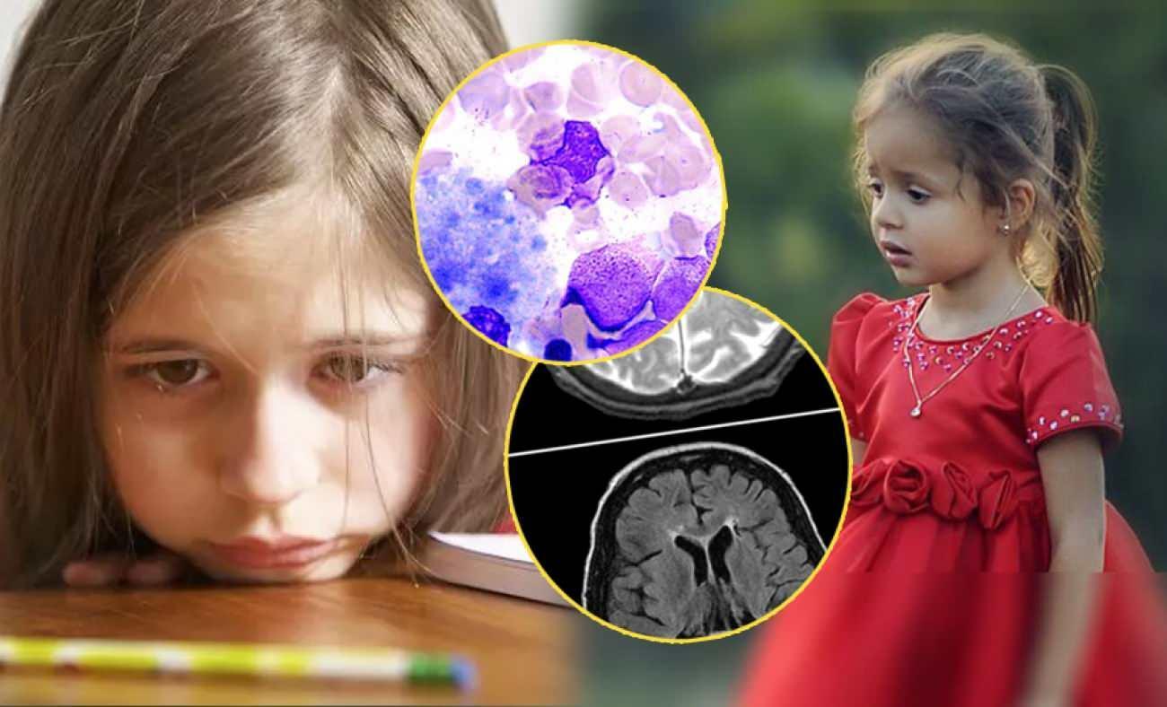 Çocukluk bunaması nedir, nasıl tedavi edilir? Niemann-Pick hastalığı ve ...