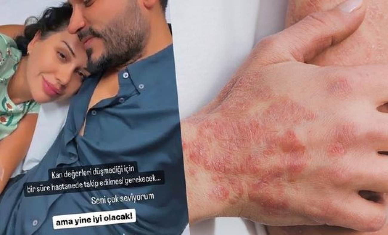 Dilan Polat ne hastası? Lupus hastalığı neden olur? Dilan Polat'ın ... Dilan Polat ne hastası? Lupus hastalığı neden olur? Dilan Polat'ın ...
